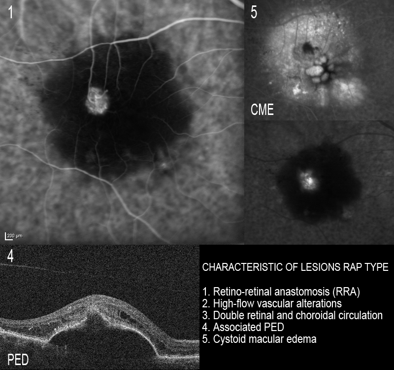 Diagnostic usefulness of indocyanine green angiography (ICGA) in age ...