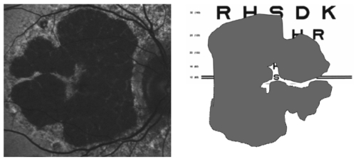 Fundus autofluorescence patterns and optical coherence tomography in ...