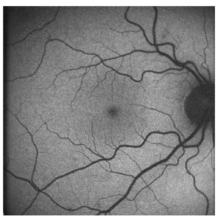 Fundus autofluorescence patterns and optical coherence tomography in ...
