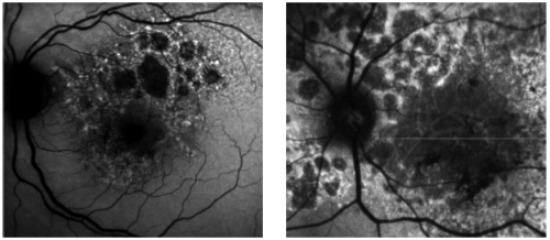 Fundus autofluorescence patterns and optical coherence tomography in ...