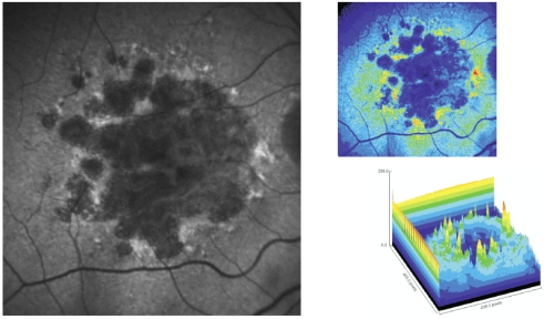 Fundus autofluorescence patterns and optical coherence tomography in ...