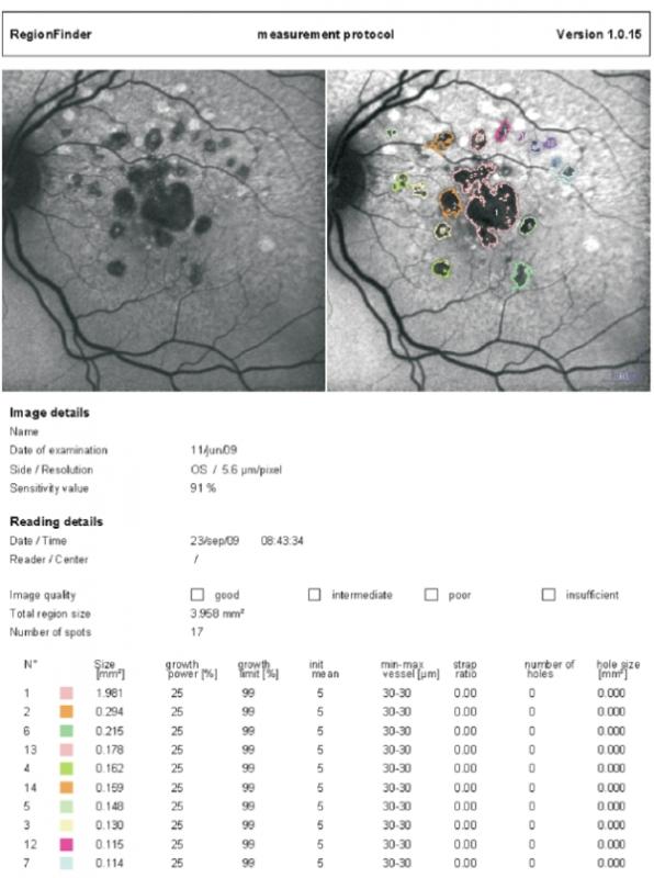 Fundus autofluorescence patterns and optical coherence tomography in ...