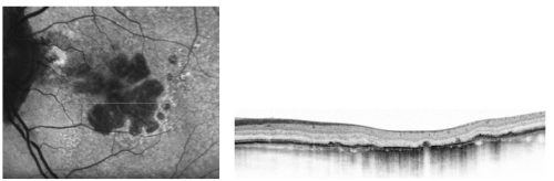 Fundus autofluorescence patterns and optical coherence tomography in ...