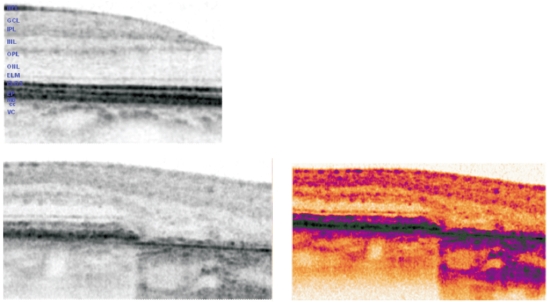 Fundus autofluorescence patterns and optical coherence tomography in ...