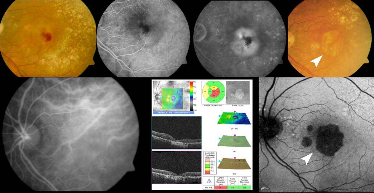 Diagnostic usefulness of indocyanine green angiography (ICGA) in age ...