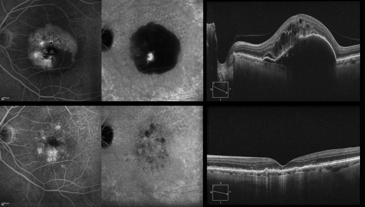 Diagnostic usefulness of indocyanine green angiography (ICGA) in age ...
