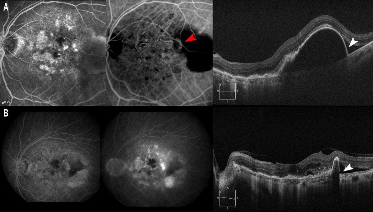 Diagnostic usefulness of indocyanine green angiography (ICGA) in age ...