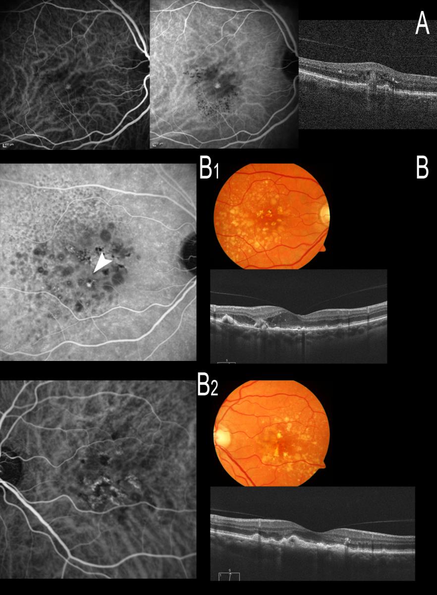 Diagnostic usefulness of indocyanine green angiography (ICGA) in age ...