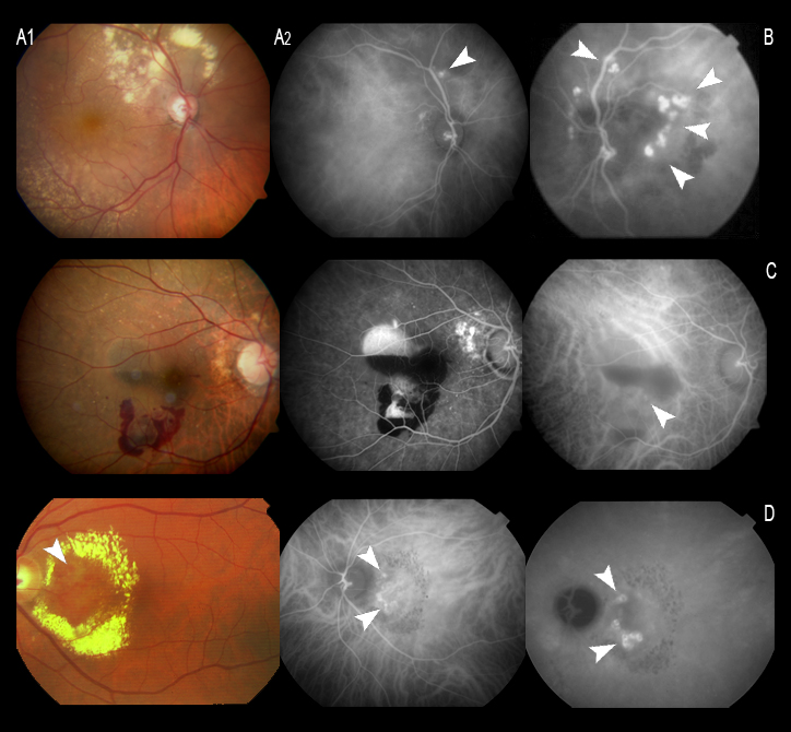 Diagnostic usefulness of indocyanine green angiography (ICGA) in age ...