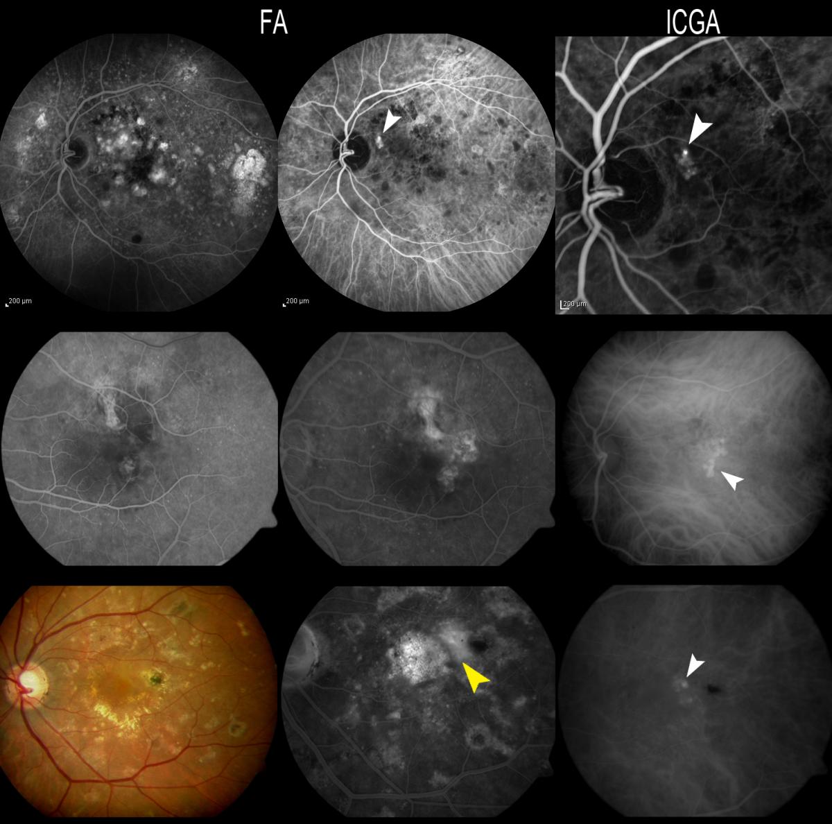 Diagnostic usefulness of indocyanine green angiography (ICGA) in age ...