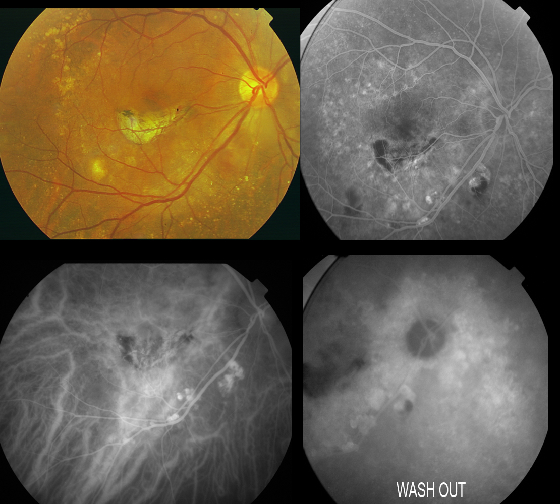 Diagnostic usefulness of indocyanine green angiography (ICGA) in age ...