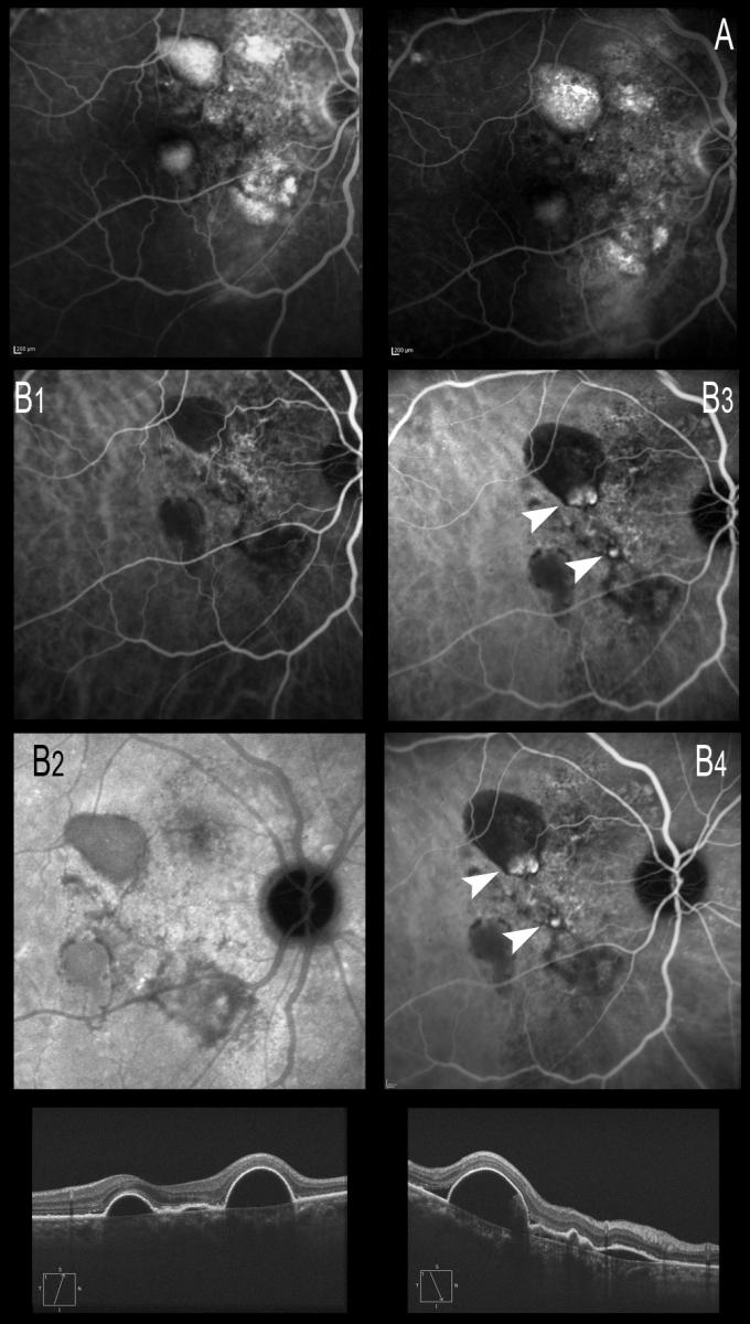 Diagnostic usefulness of indocyanine green angiography (ICGA) in age ...