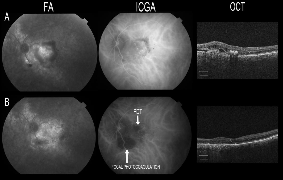 Diagnostic usefulness of indocyanine green angiography (ICGA) in age ...