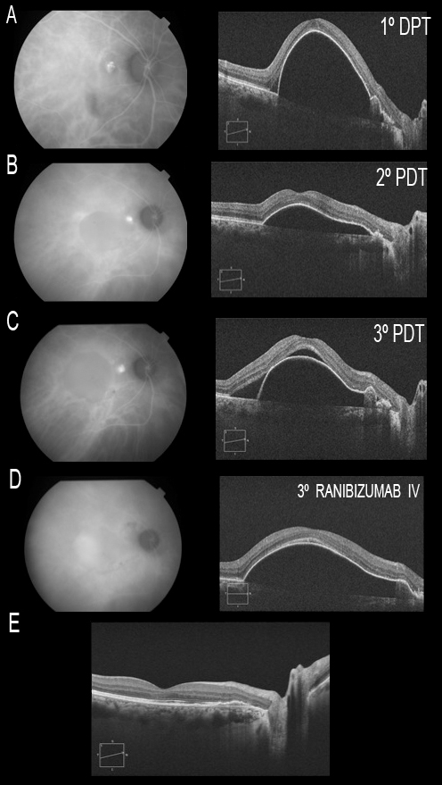 Diagnostic usefulness of indocyanine green angiography (ICGA) in age ...